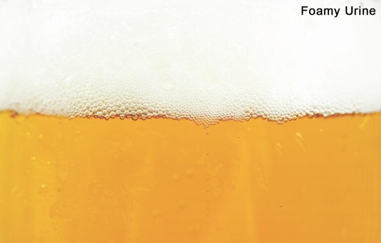 Foamy Urine in the Morning | Symptoms Diagnosis Treatment - Fertilityworld